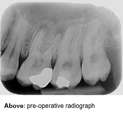 Pulp Stones - friend or foe?