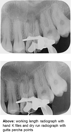 Pulp Stones - friend or foe?